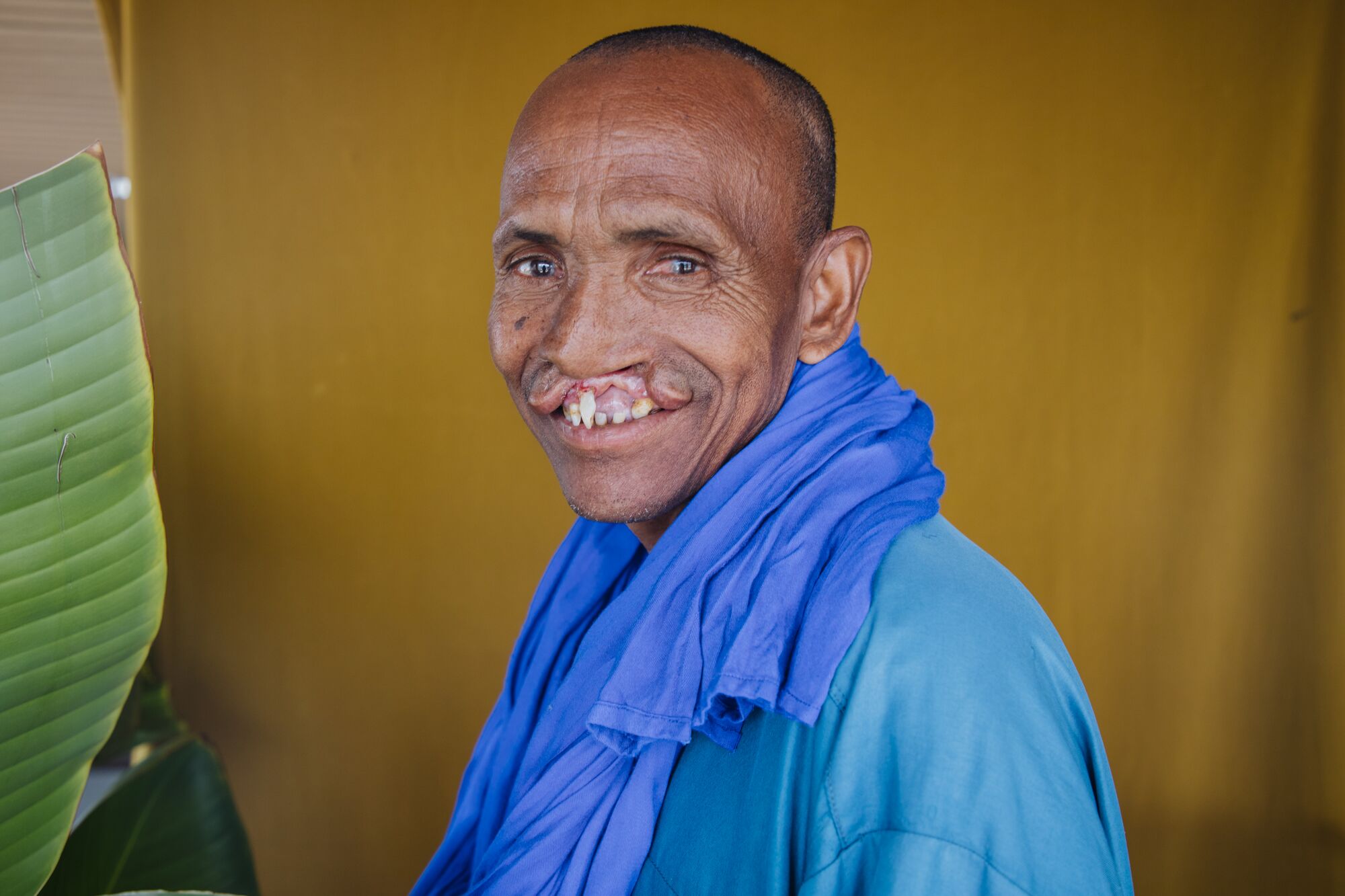 Life-changing Healing for Samba - Mercy Ships Africa